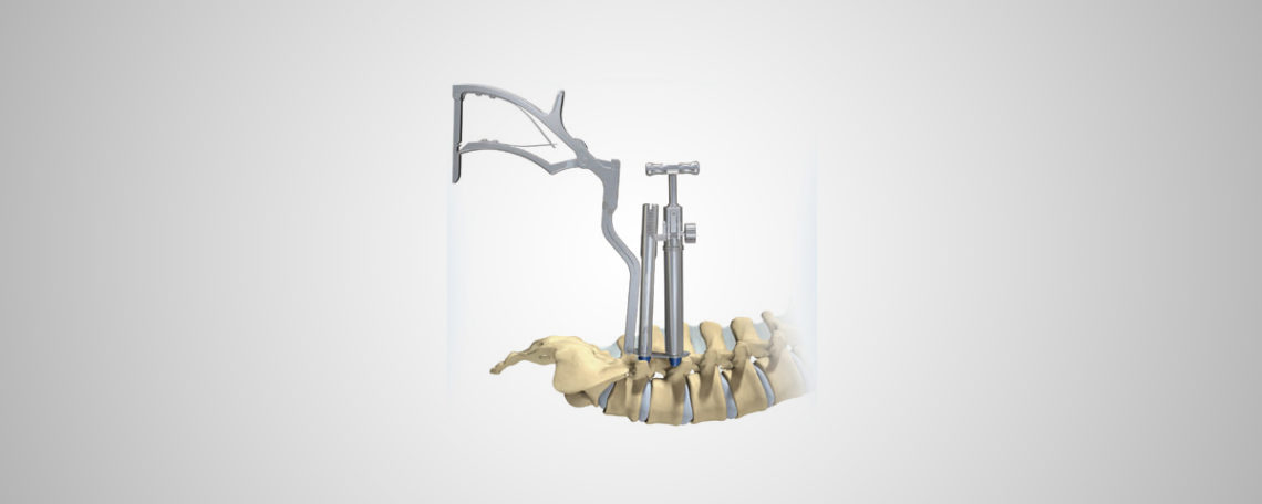 Minimal Invasive Spine System (MISS) - Atron